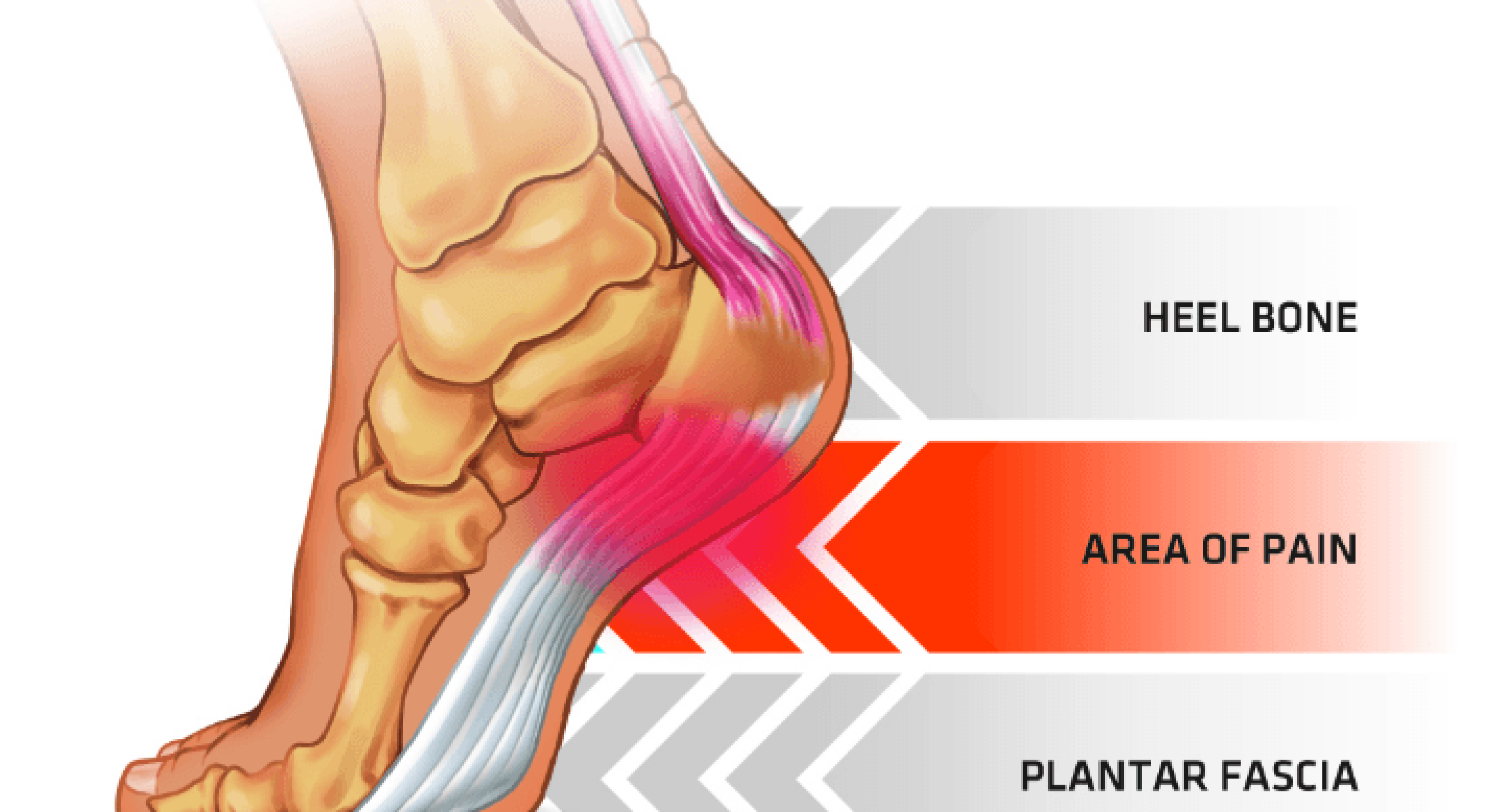What’s the Difference Between Plantar Fasciitis and Heel Spurs ...